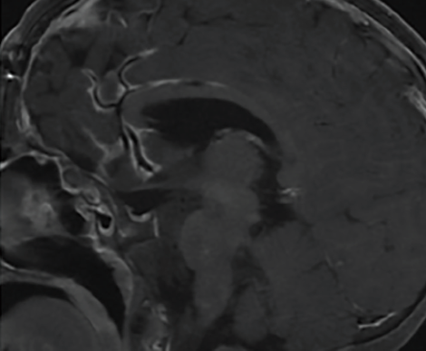 Stroke Snapshot: Intracranial MRI Vessel-Wall Imaging