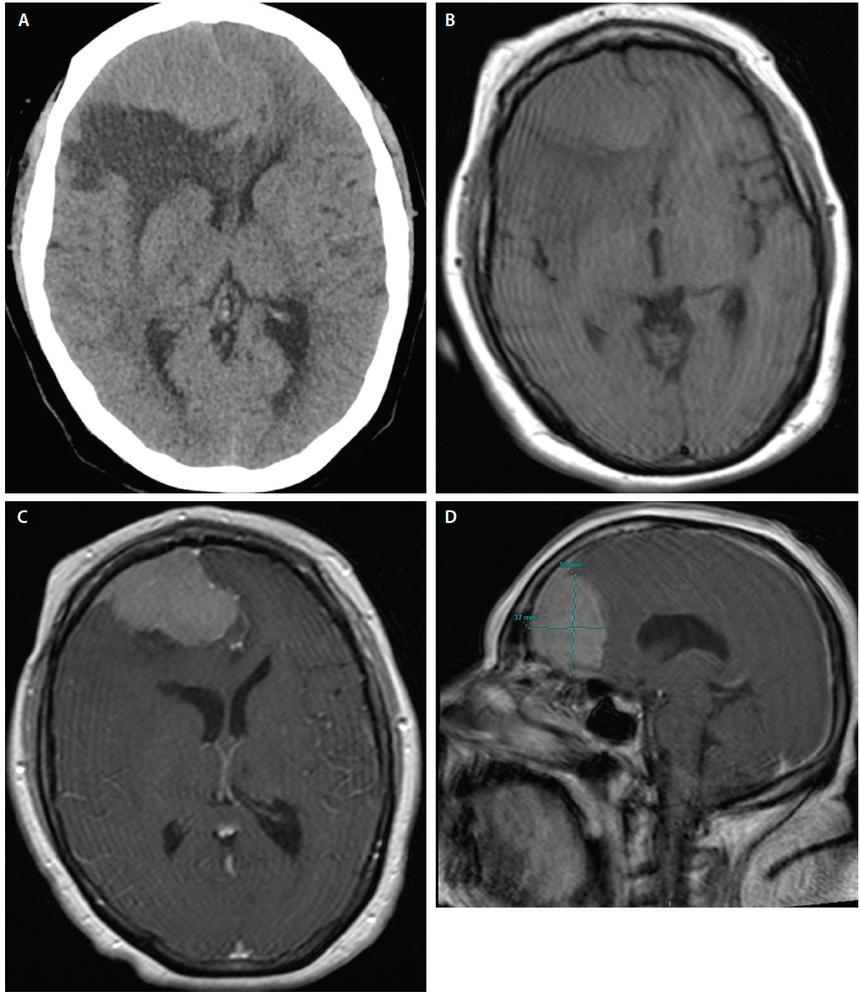 Special Report: Neuro-oncology
