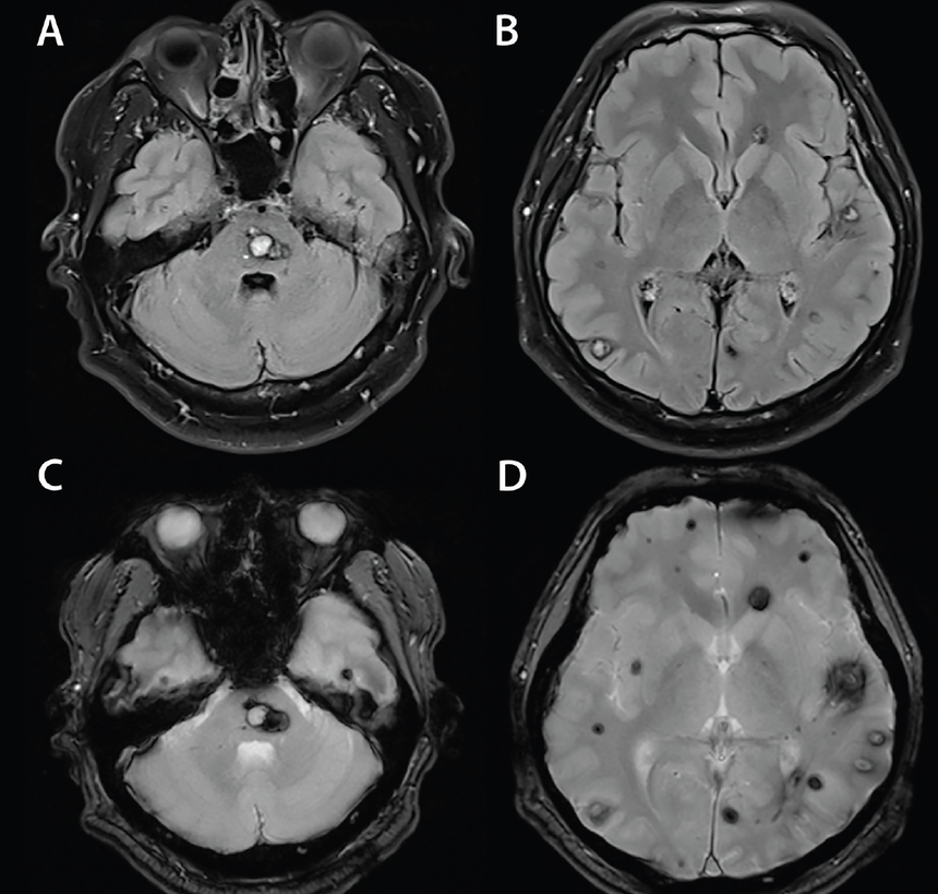 Familial Cerebral Cavernous Malformation