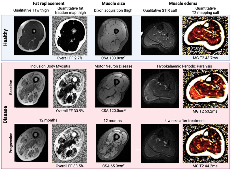 Imaging Outcome Measures in Neuromuscular Diseases