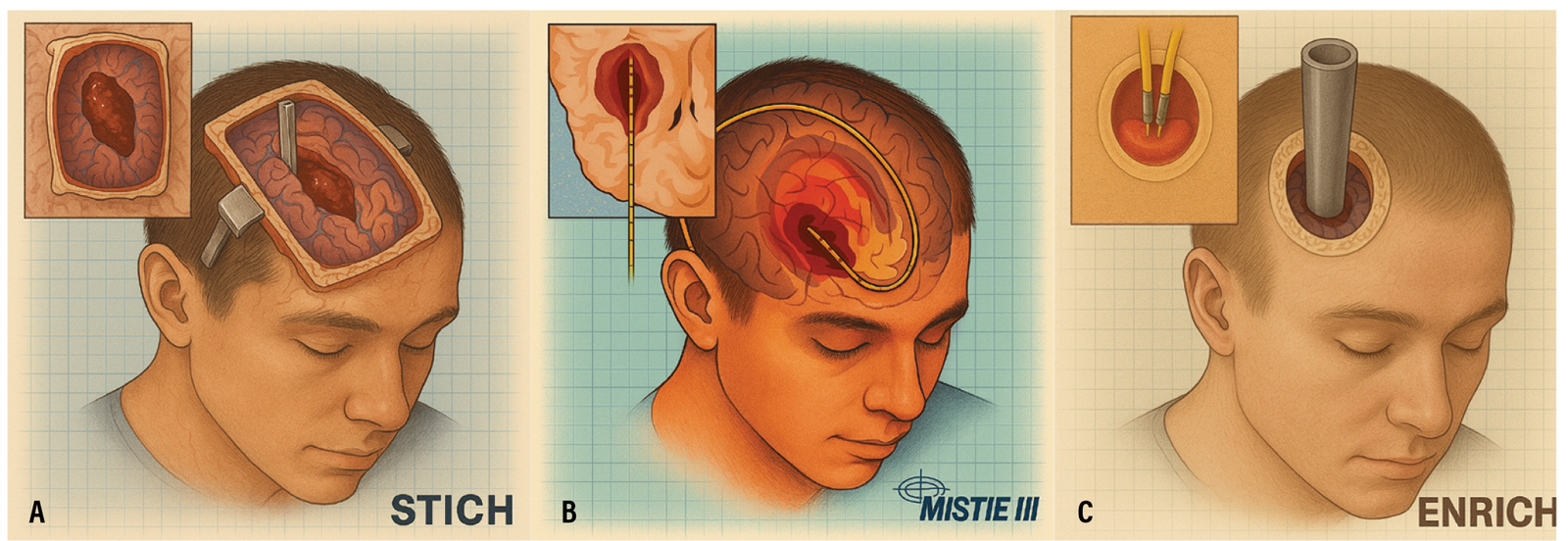 Intracerebral Hemorrhage—Surgery and the Future of Trials