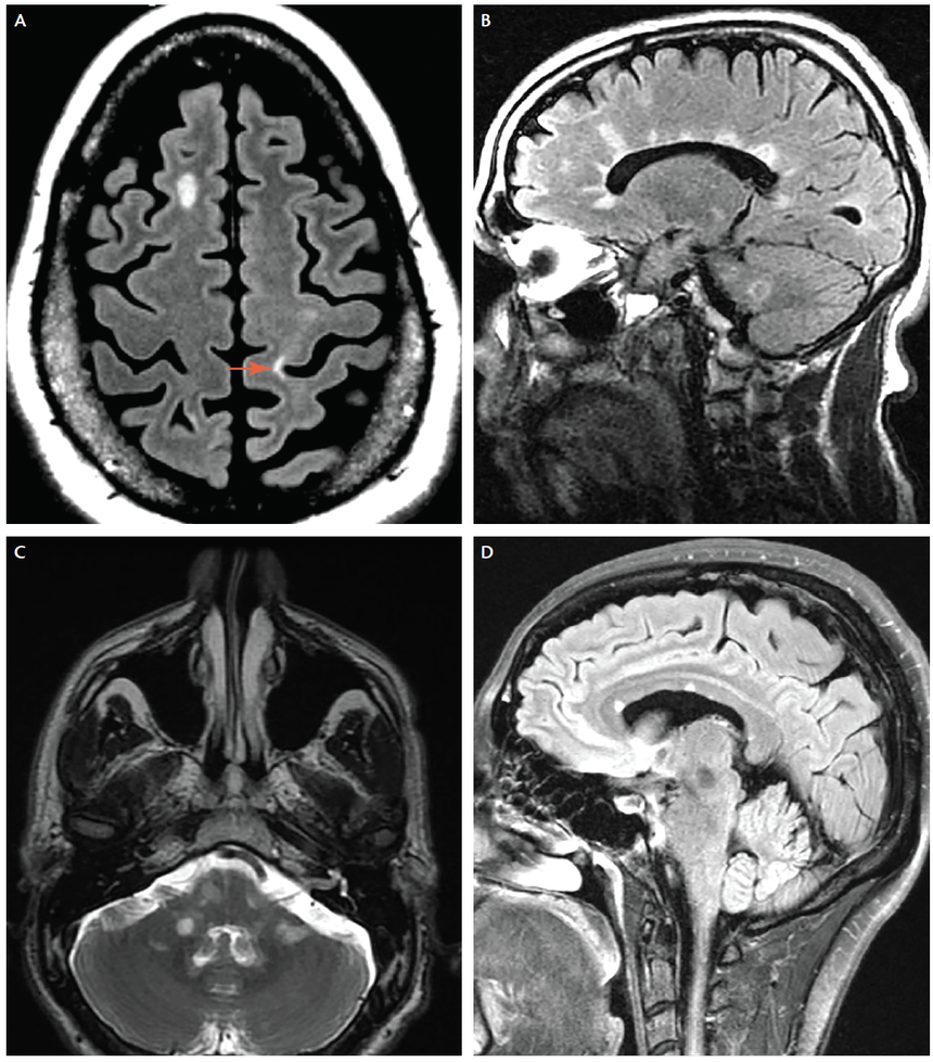 Multiple Sclerosis Mri