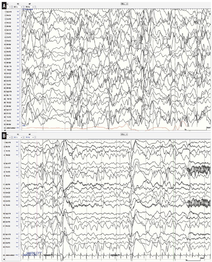 Epilepsy EssentialsInfantile Spasms: The Biggest Little Seiz