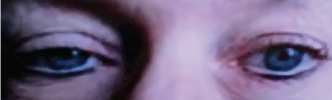 Teleneuro-ophthalmology