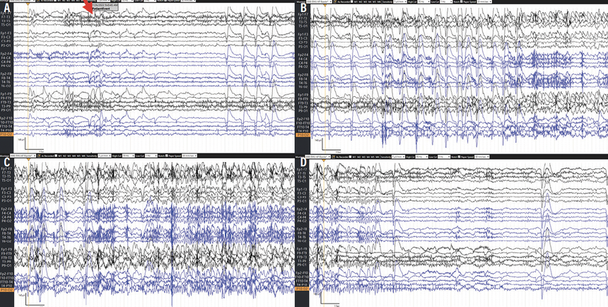 A Case of Anti–GAD65 Autoimmune Musicogenic Epilepsy