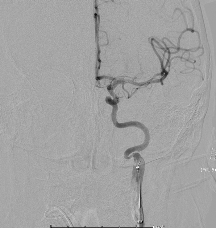 Acute Ischemic Stroke in the Third Trimester of Pregnancy