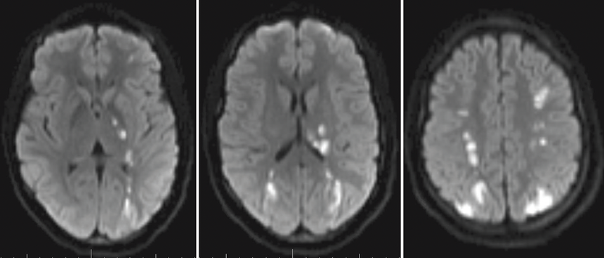 Stroke in a Young Adult:Immunomodulation-Responsive Bilatera