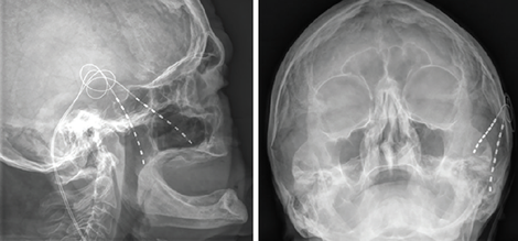 Implantable Neuromodulation for Chronic Pain & Headache