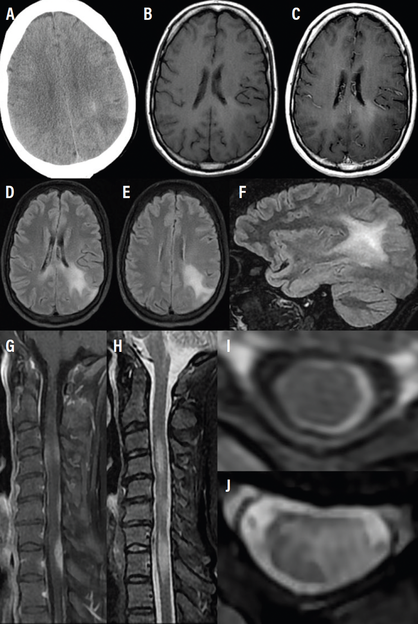 Challenge Case Report: Acute Onset of Expressive Aphasia, Vi