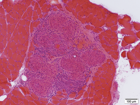 Neuromuscular Sarcoidosis: Peripheral Nervous System Manifes