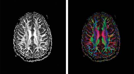 Reversible and Benign Lesions of Splenium of The Corpus Coll