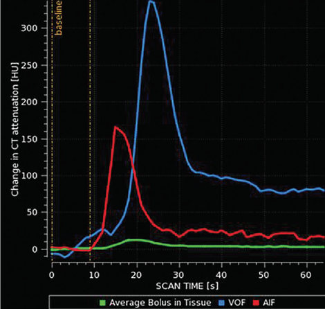 RAPID Automated CT Perfusion in Clinical Practice