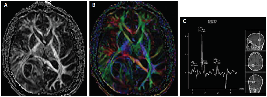 Brain Tumor Imaging