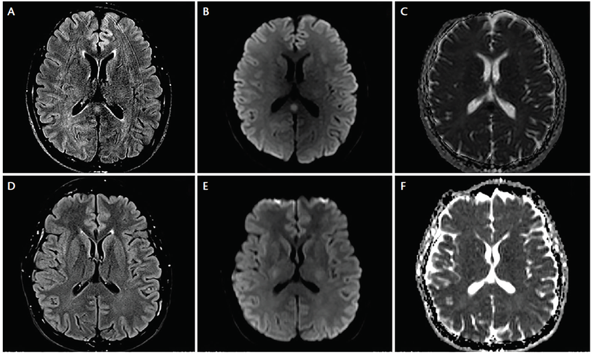 Reversible and Benign Lesions of Splenium of The Corpus Coll