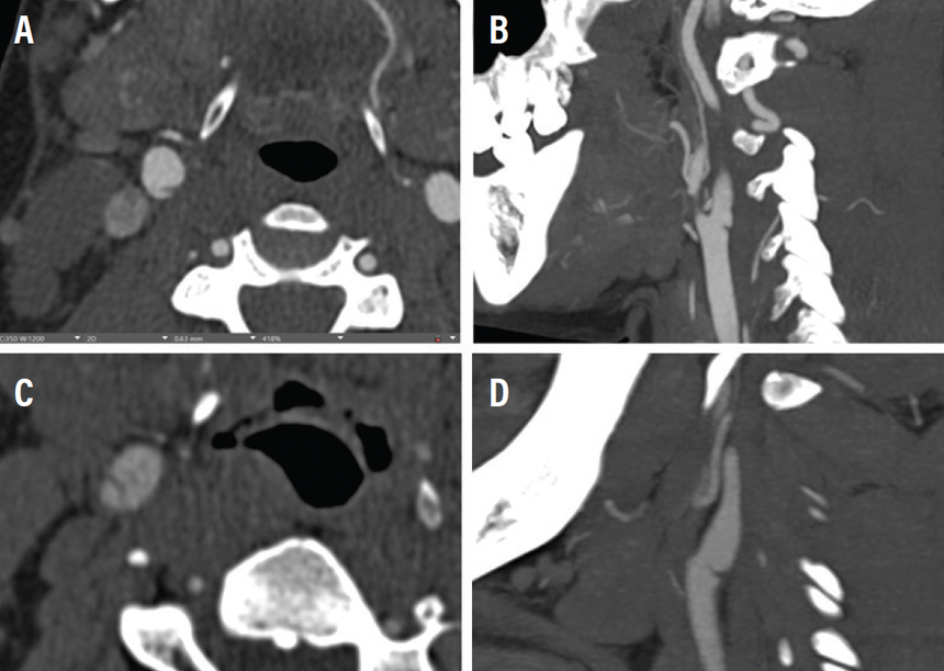 Stroke Snapshot: Carotid Artery Webs—Epidemiology and Pathop