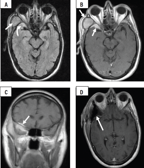 Sphenoid Wing Meningioma Presenting With a Temporal Fossa Ma
