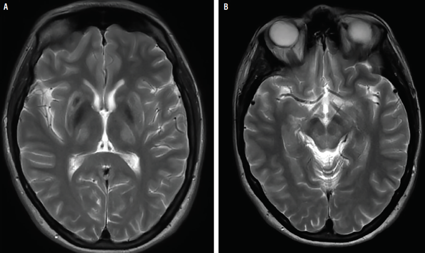 Wilson Disease