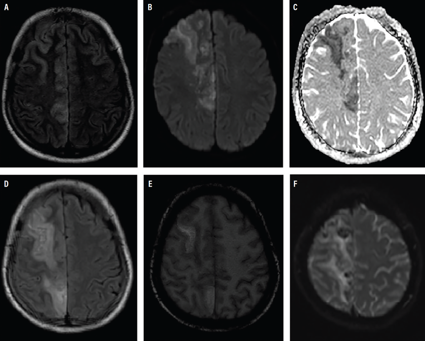 Ischemic Complications from a Facial Lipofilling Procedure