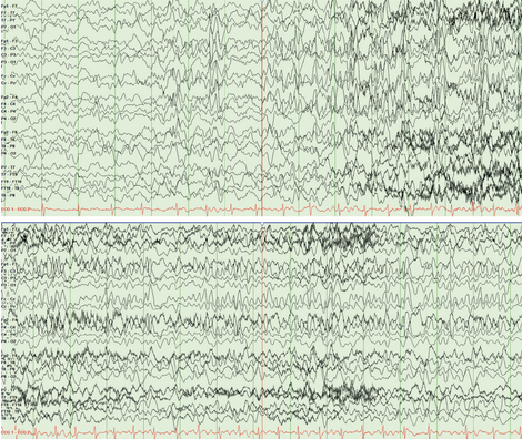Spotlight on Sleep:Dispelling the Sleep Spell: Hypermotor Se