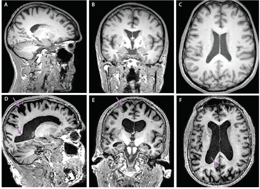 Neuroimaging and Alzheimer’s Disease