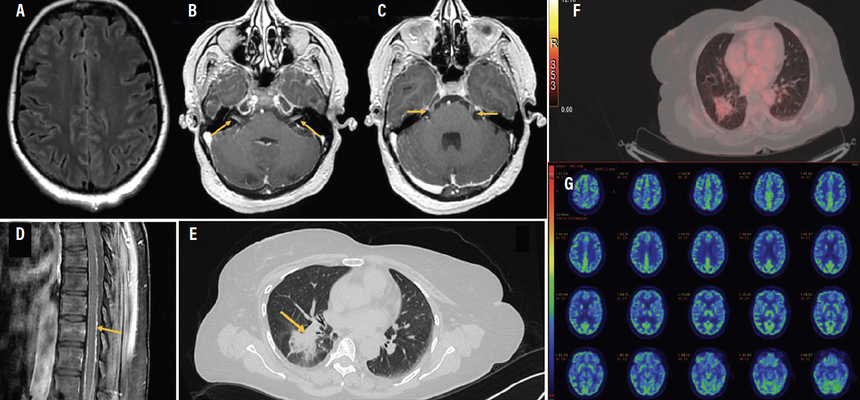 Rapidly Progressive Dementia and Plateau Waves: A Rare Prese
