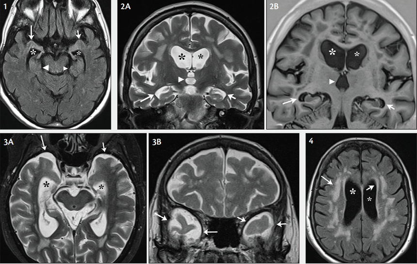 Amyotrophic Lateral Sclerosis with Atrophy of the Amygdala