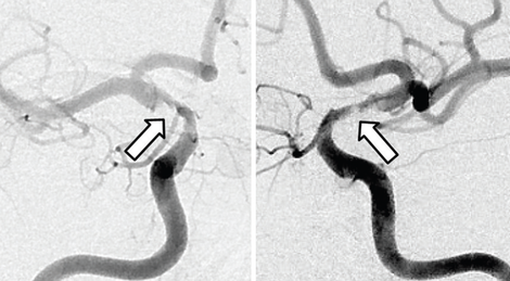 Stroke in a Young Adult:Immunomodulation-Responsive Bilatera