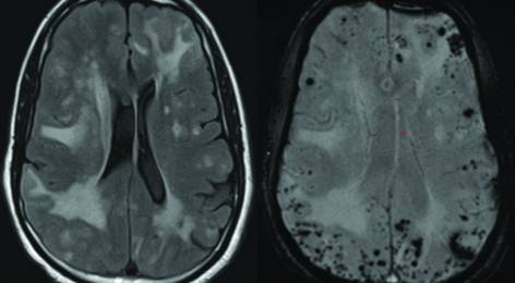 Spontaneous Intracranial Hemorrhage Secondary to Rare Pial A
