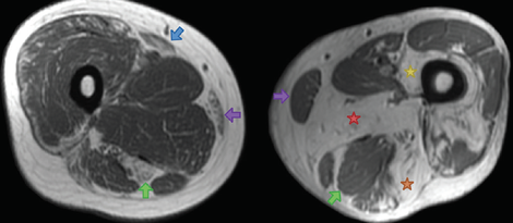 Muscle MRI for Neuromuscular Disorders