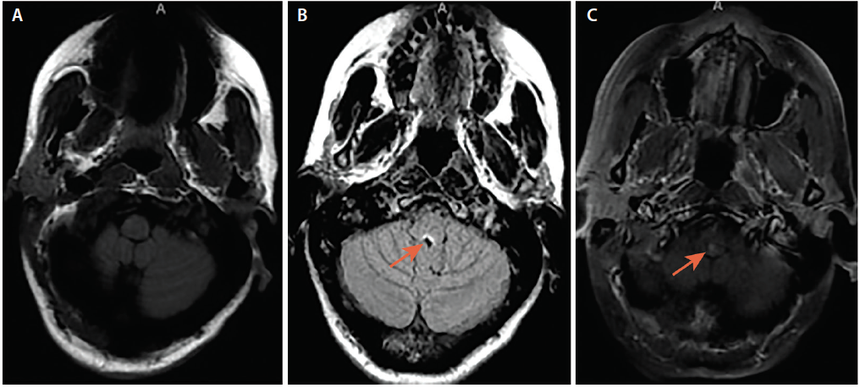Case Report: Neuromyelitis Optica Associated With SARS-CoV-2