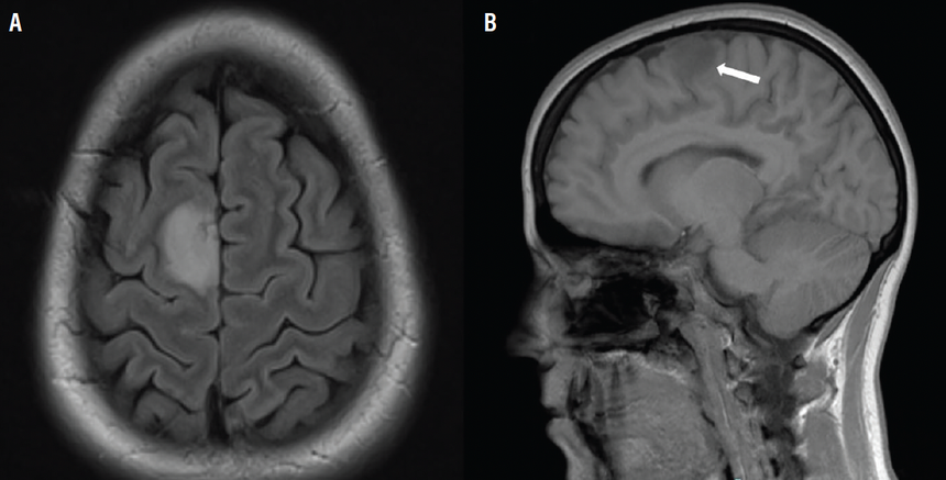 Supplementary Motor Area Glioma Presenting with Musicogenic