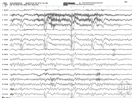 Self-Limited Focal Epilepsies in Childhood