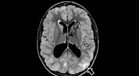 Tics and Tourette Syndrome