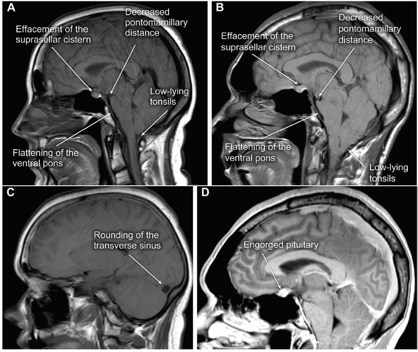 Spontaneous Intracranial Hypotension