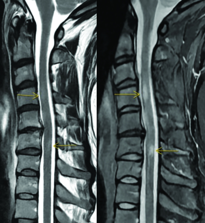 Radiologic Biomarkers in Multiple Sclerosis