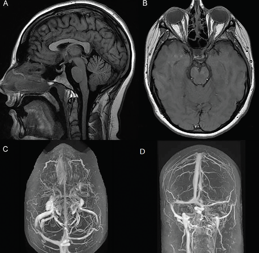 Idiopathic Intracranial Hypertension