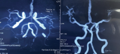 Disulfiram-Ethanol Reaction Causing Cortical Blindness