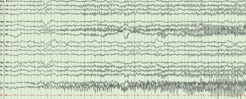 Focal Status Epilepticus 9 Years After Brain Abscess