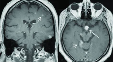 Lance-Adams Syndrome: A Case Report
