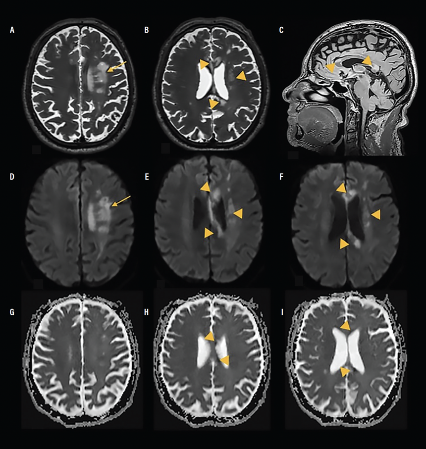 Corpus Callosum Stroke:A Rare Localization for an Isolated C