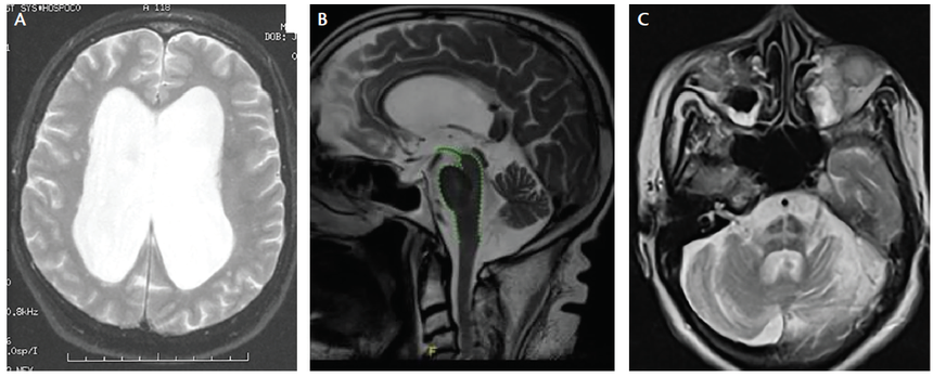 Imaging in Parkinson’s Disease