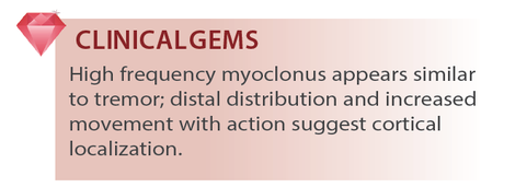 Video Case Report: Action Myoclonus After CAR-T Cell Therapy