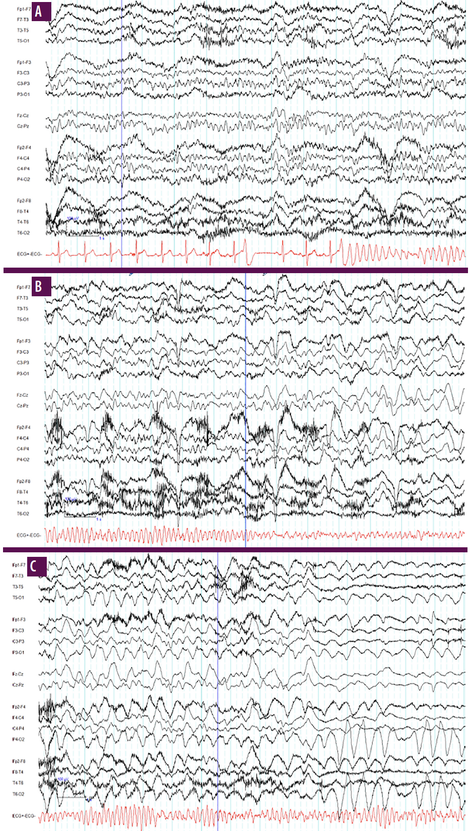 Epilepsy Essentials: VideoEEG Analysis