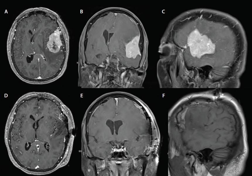 Challenge Case Report: A Woman With a Large Dural-Based Lesi