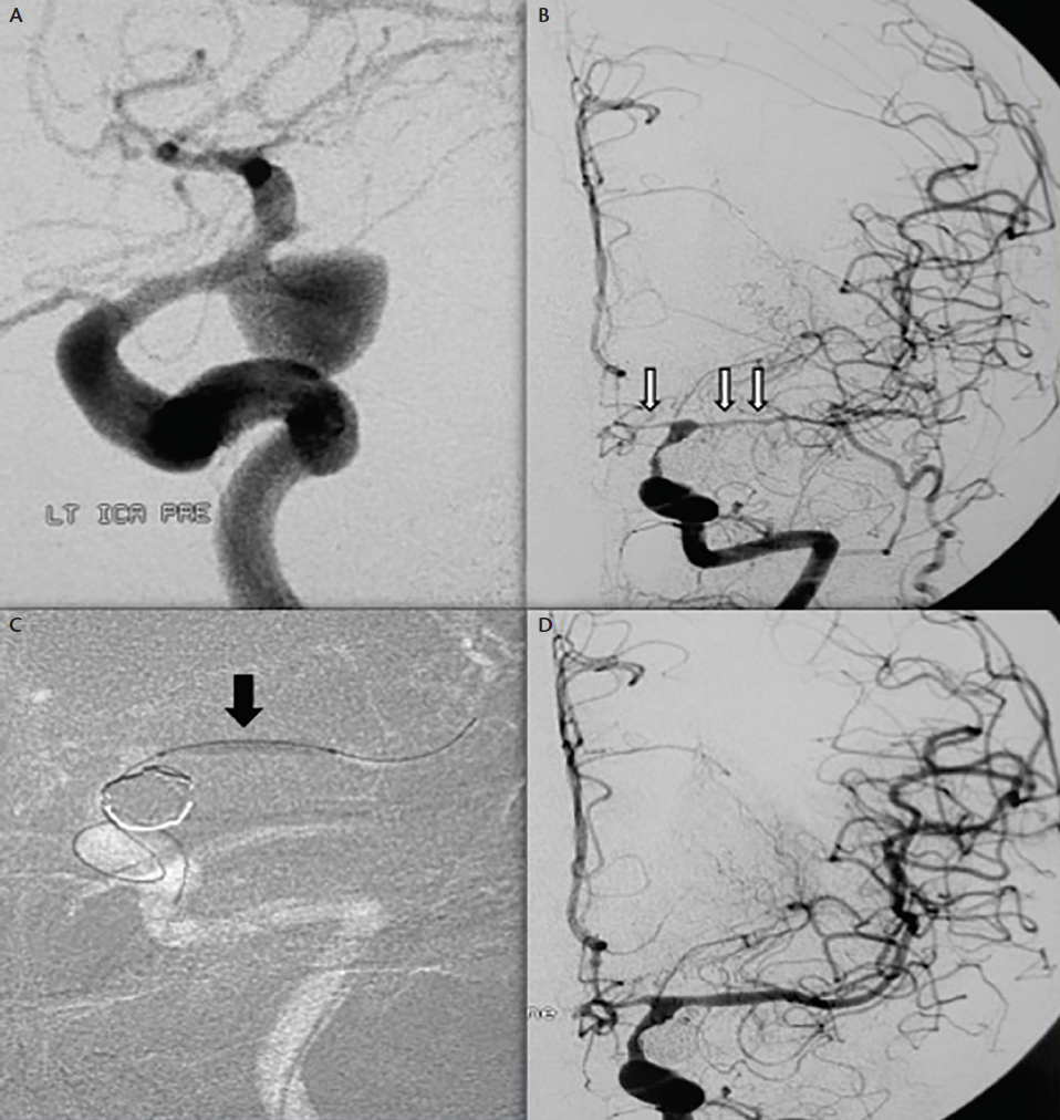 Subarachnoid Hemorrhage, Vasospasm, and Delayed Cerebral Isc