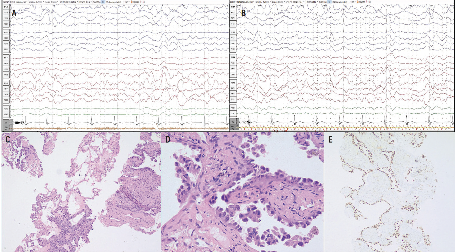 Rapidly Progressive Dementia and Plateau Waves: A Rare Prese
