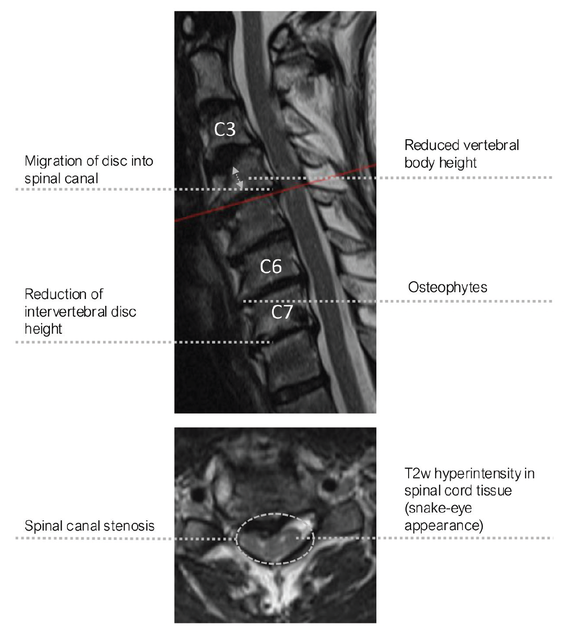 Degenerative Cervical Myelopathy as a Neuromuscular Mimicker