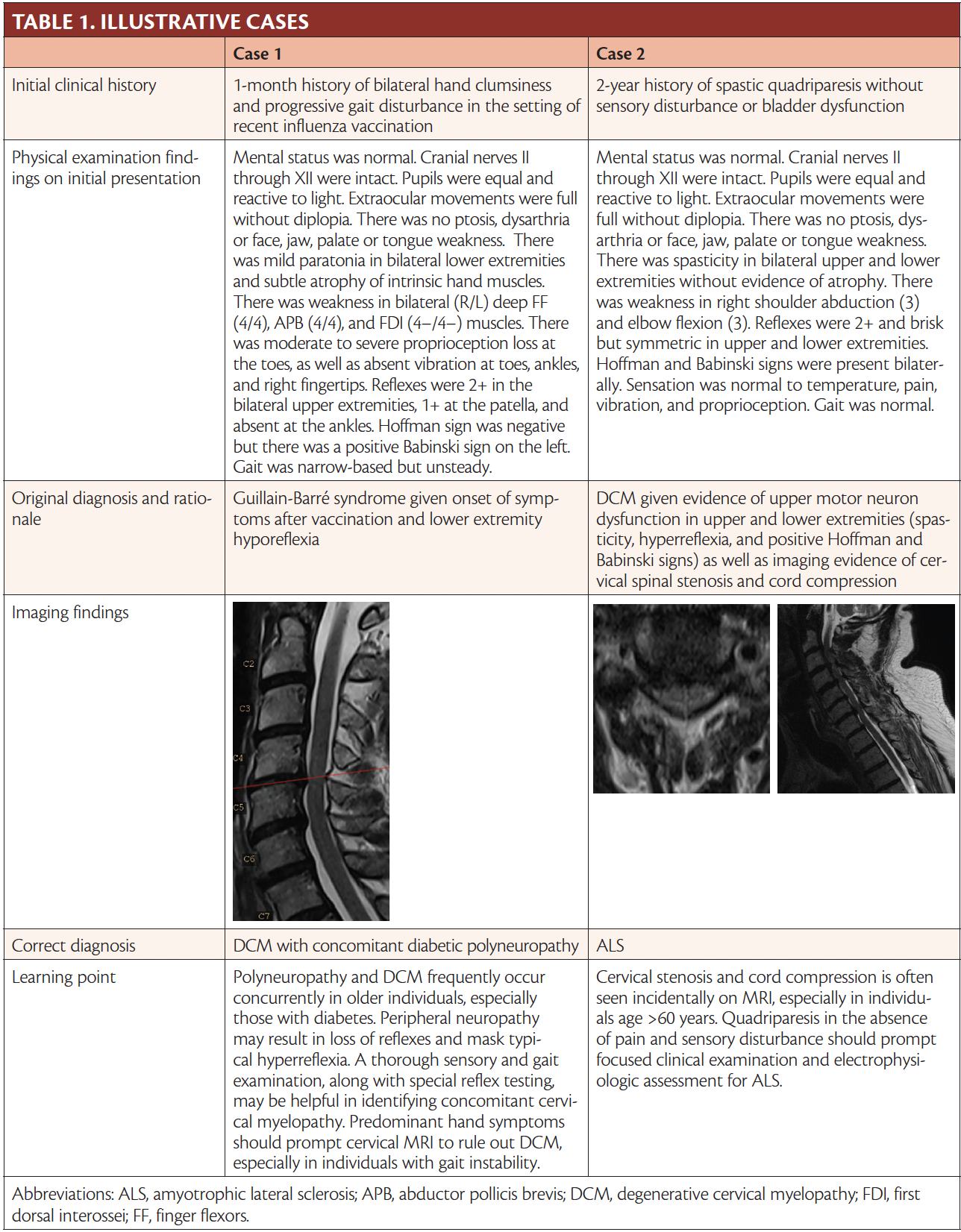 Degenerative Cervical Myelopathy as a Neuromuscular Mimicker