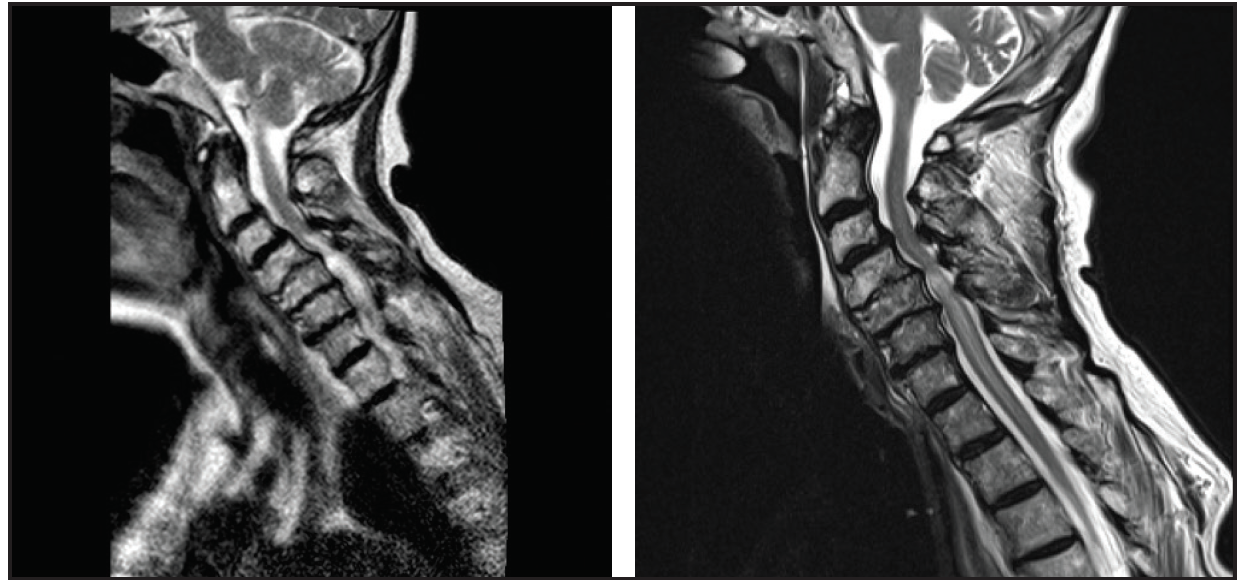 Spinal Cord Infarct: Clinical & Imaging Pearls