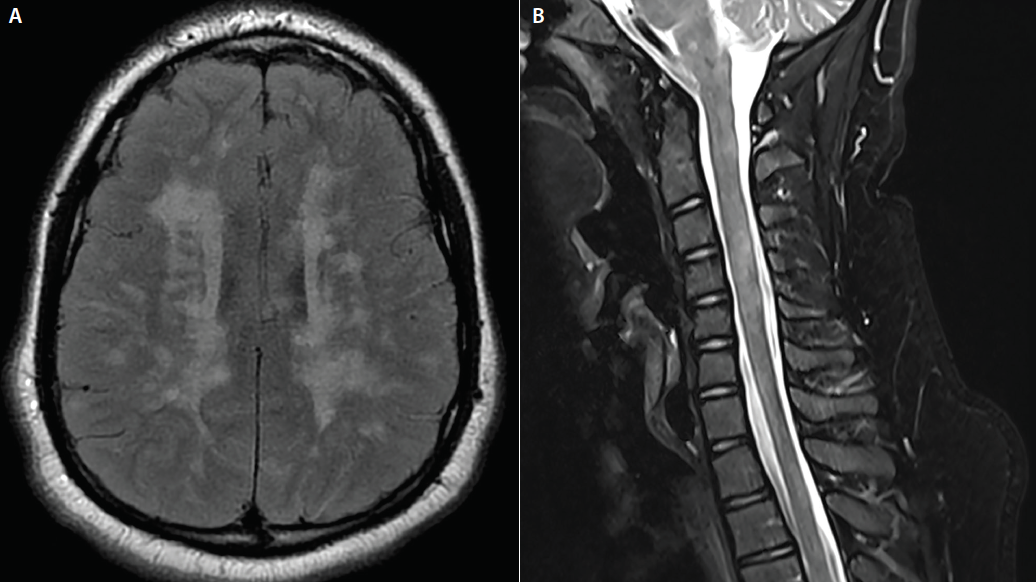Pediatric-Onset Multiple Sclerosis
